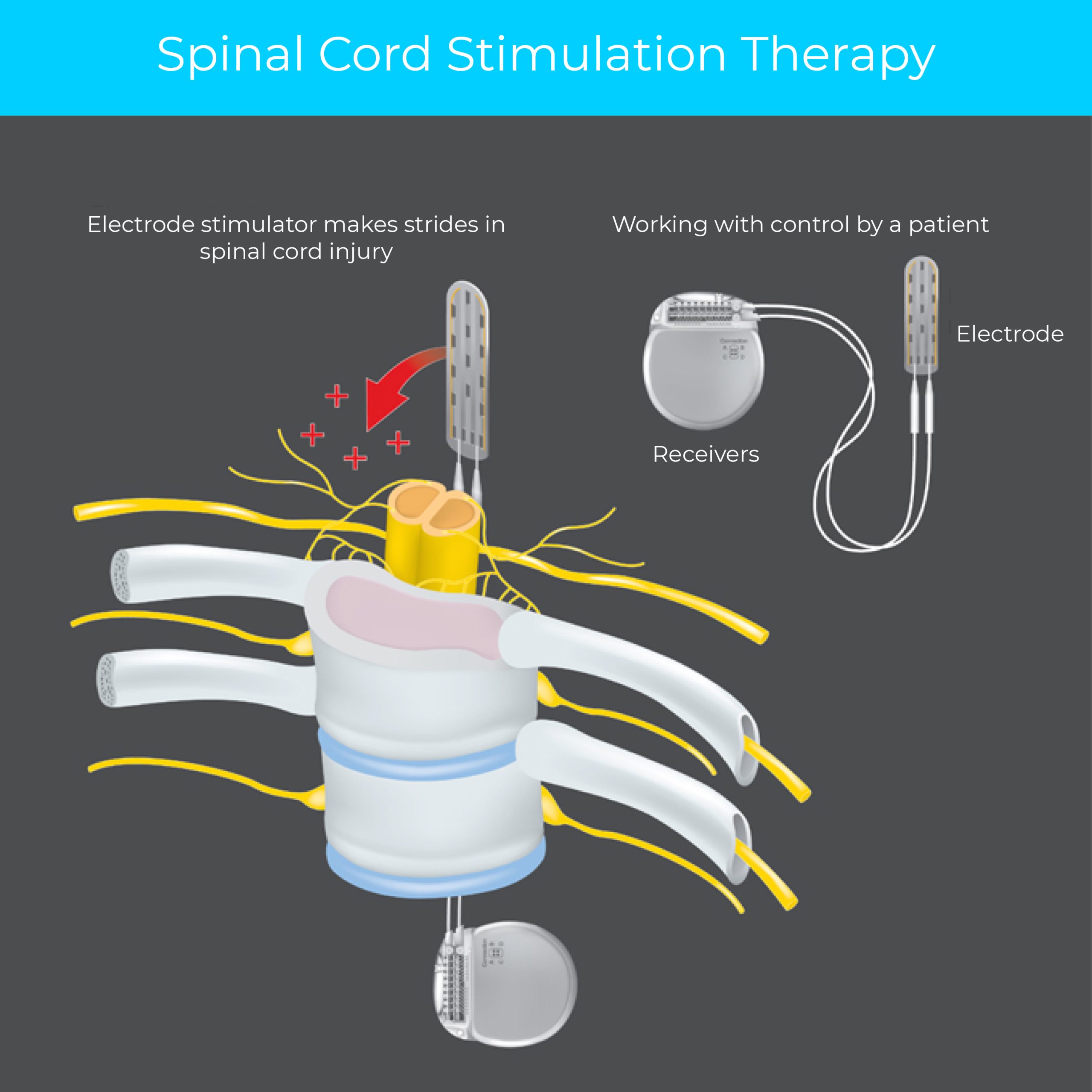 Spinal Cord Stimulator - AVALA Spine